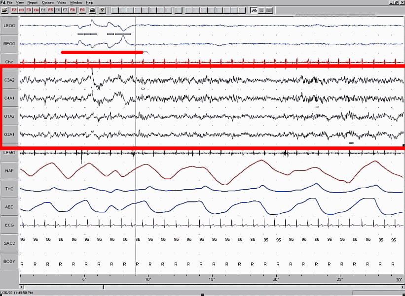 RAS and the Sleep-Wake Cycle - Understanding the Reticular Activating ...